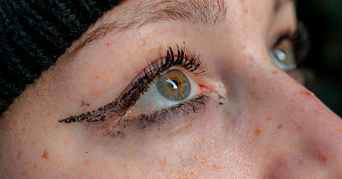 How Can I Get Rid Of Freckles Without Damaging My Skin?